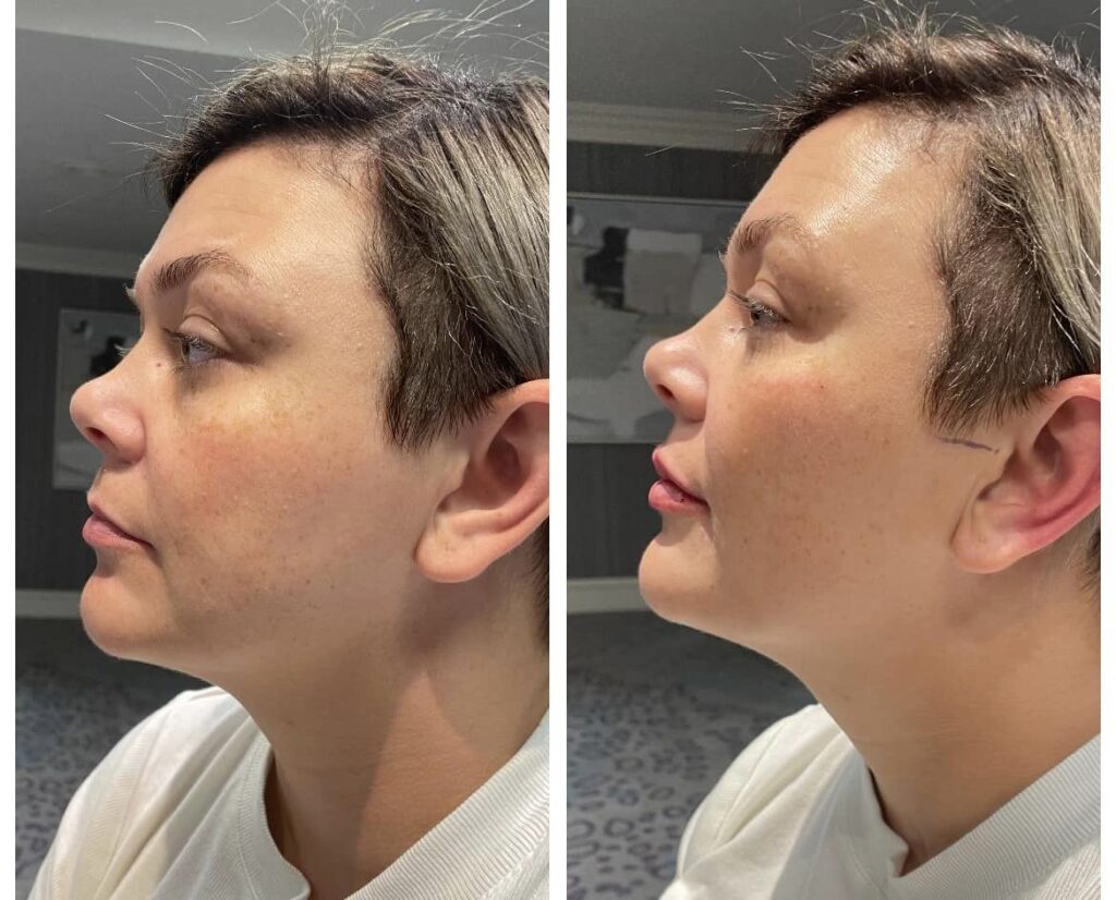 Before & After - Goddess Medspa LLC in Steele, MO